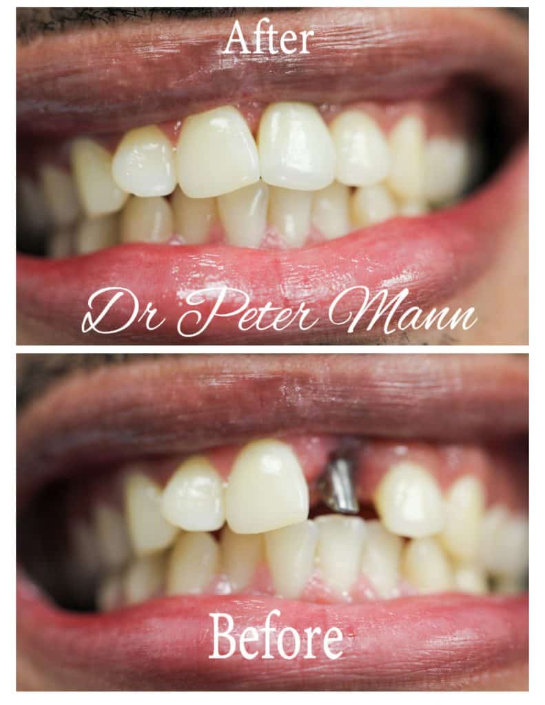 Dental Implants Before And After Photos | NYC Dentist