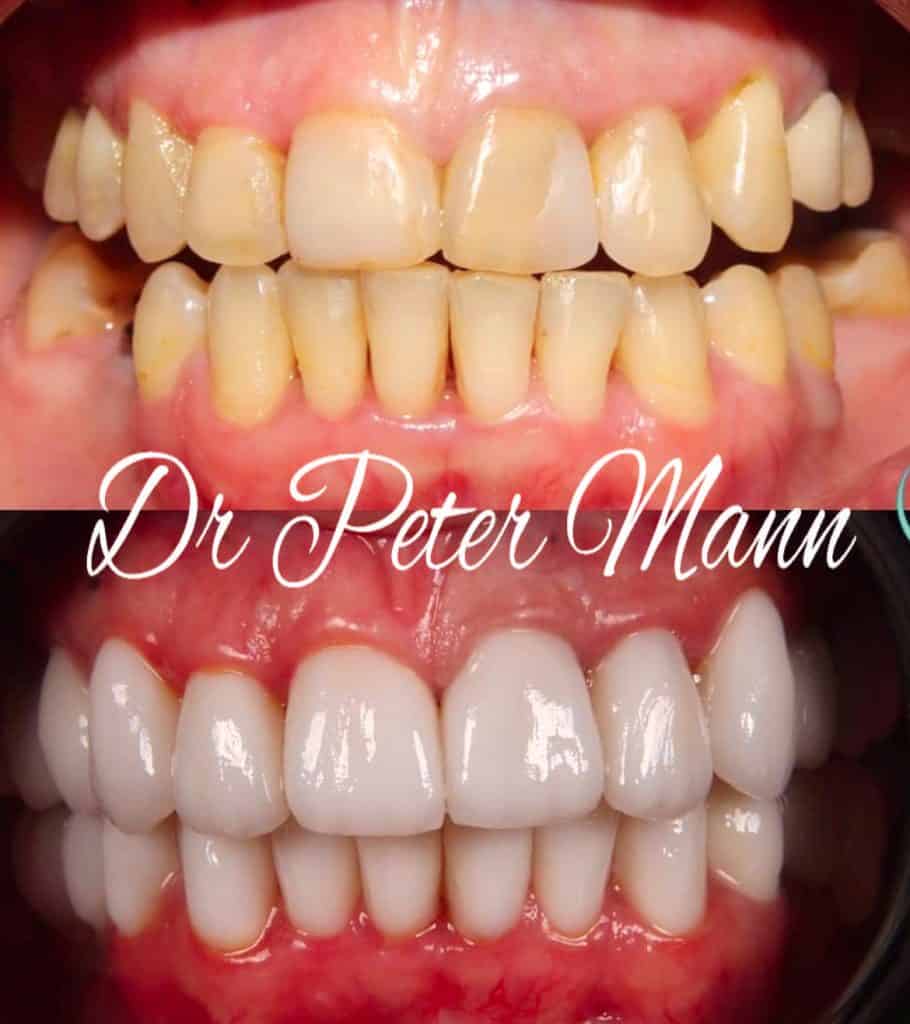 Smile MakeOver Before And After Photos | NYC Dentist