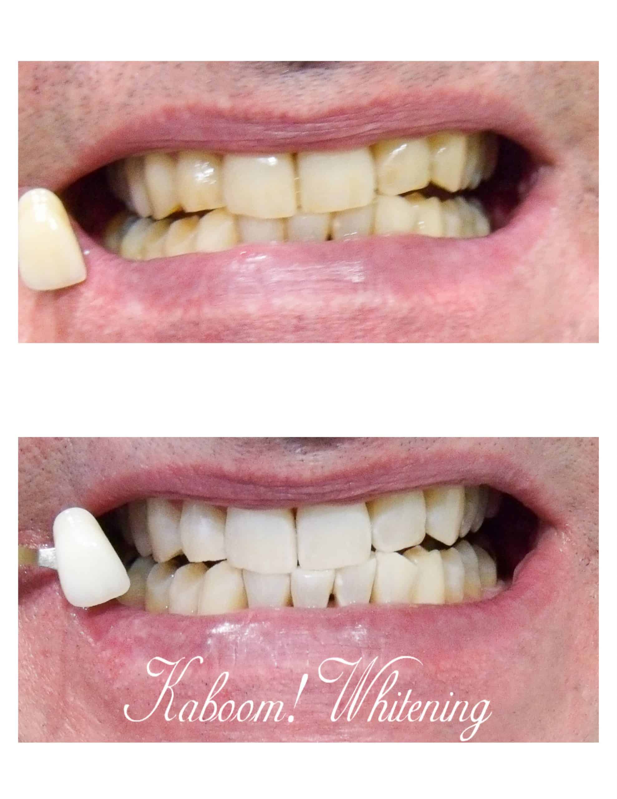 Teeth Whitening Image Gallery | Before And After Photos