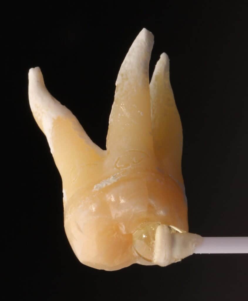 Tooth Extraction Photos | NYC Midtown Manhattan Dentist