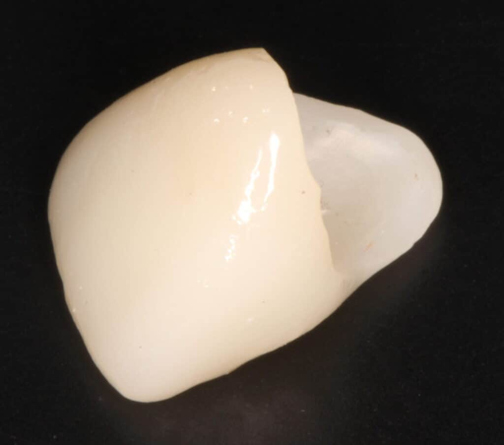 Fixing A Broken Front Tooth | NYC Emergency Dentist