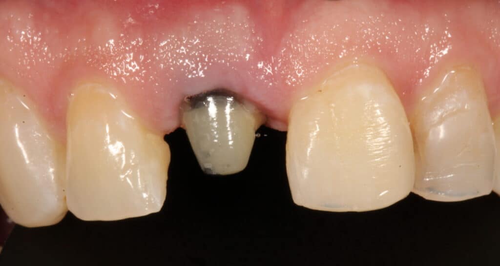 Fixing A Broken Front Tooth | NYC Emergency Dentist