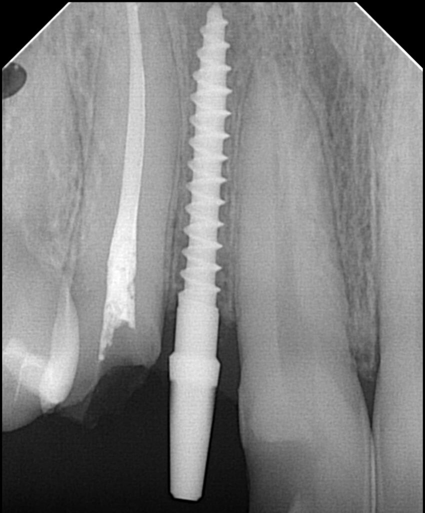 Mini Dental Implants | Dental Implants NYC | NYC Dentist